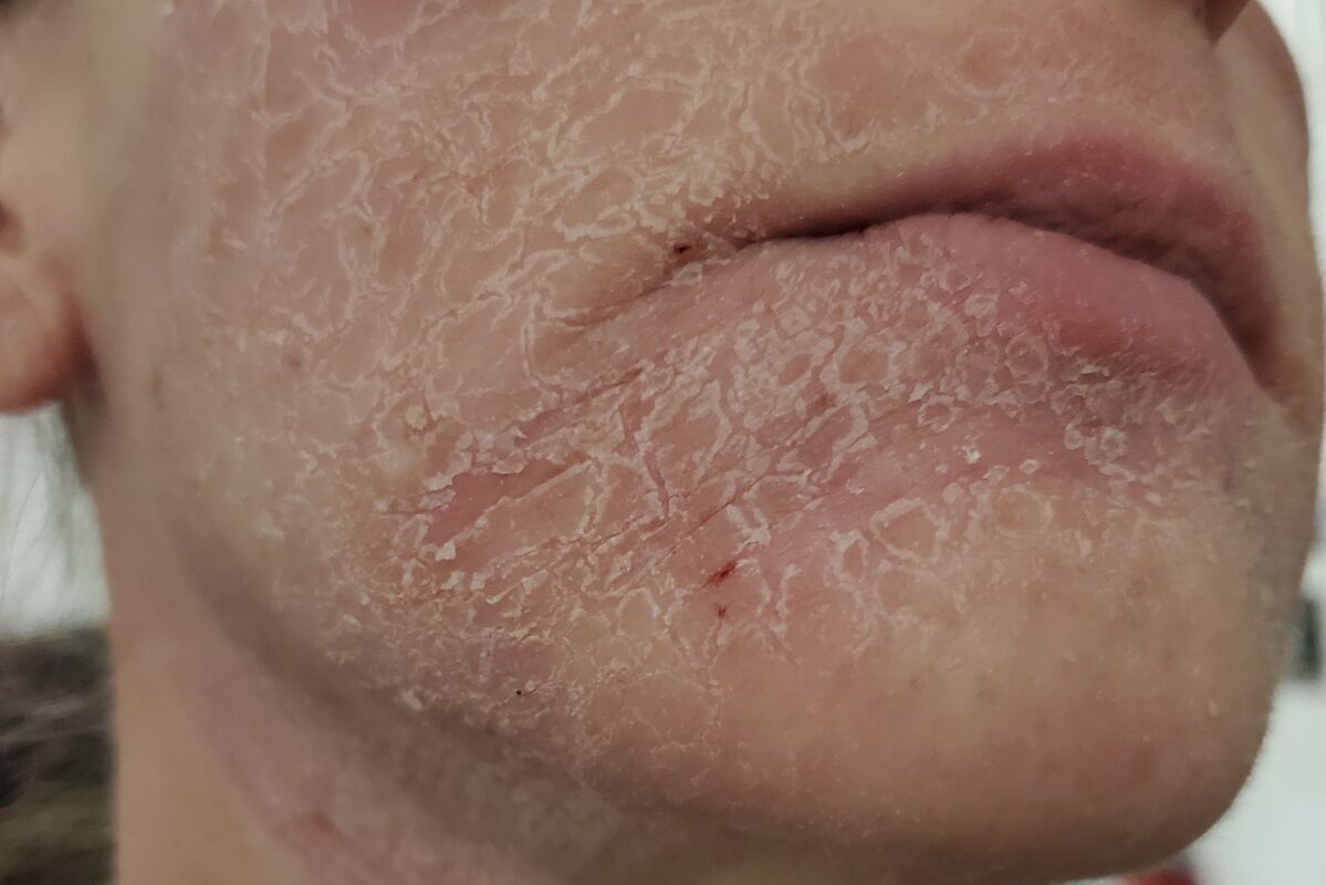 Clinical conundrum: severe eczema flare or topical steroid withdrawal ...