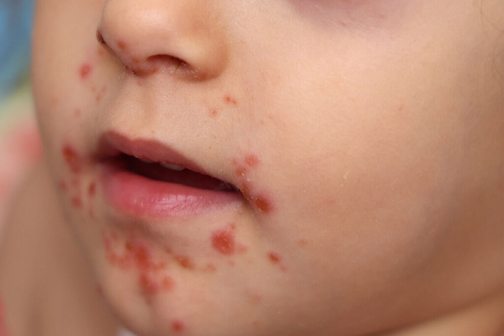 Speediatrics – what is the cause of this child's facial rash? - Pulse Today