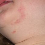 Basal cell carcinoma vs sebaceous hyperplasia - Pulse Today